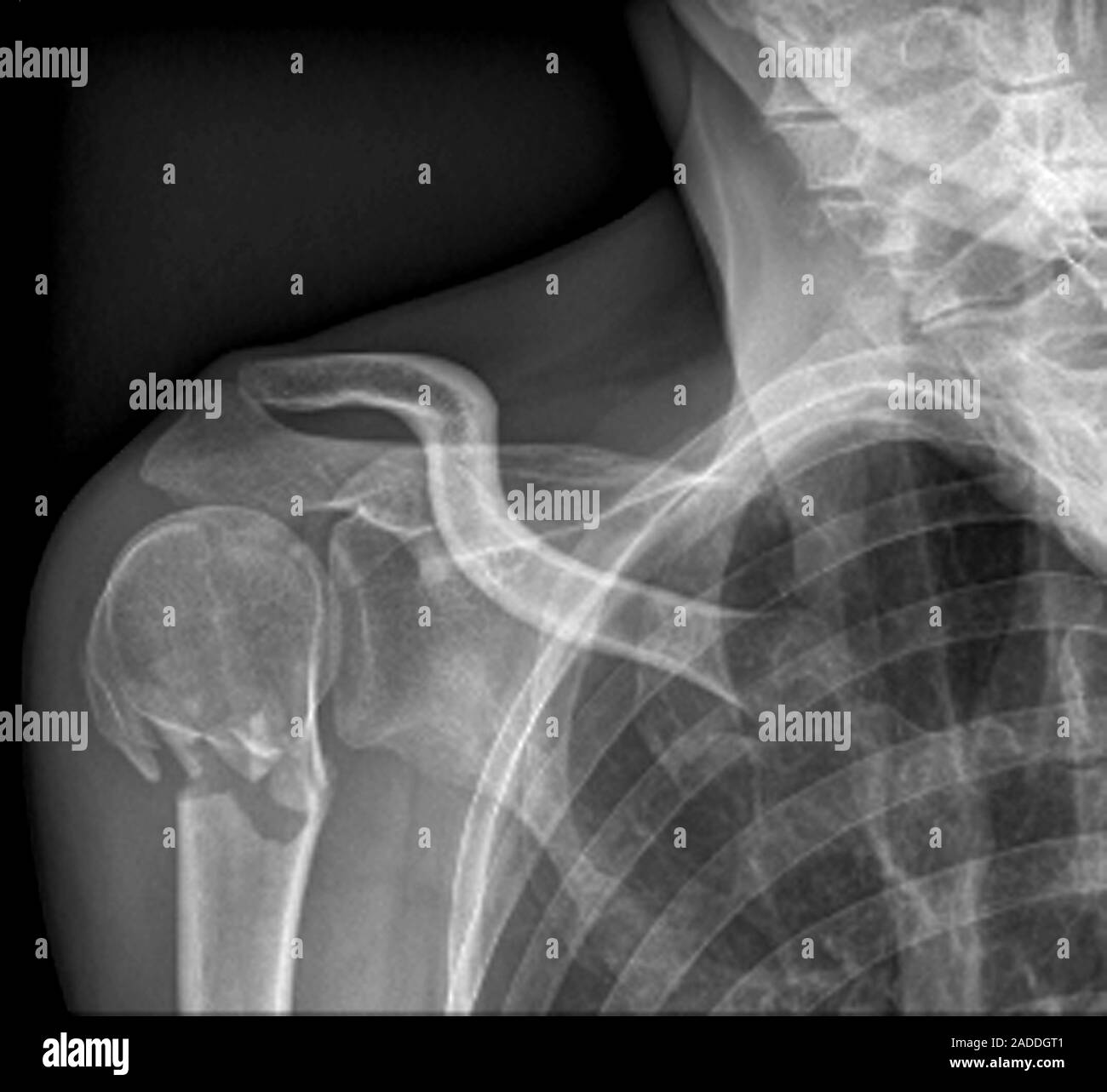 Broken upper arm bone. Frontal X-ray of the fractured right humerus ...