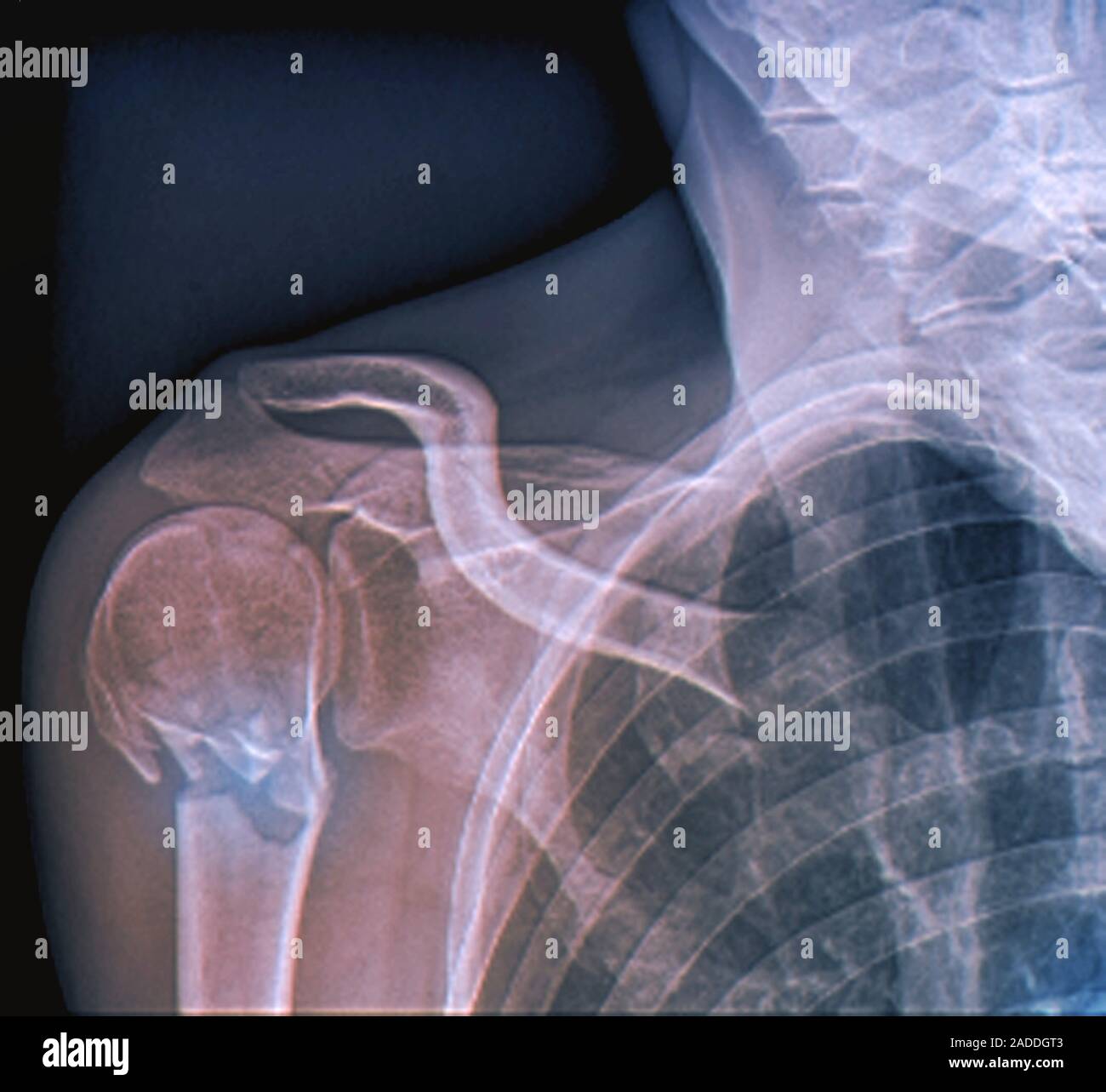 Broken upper arm bone. Coloured frontal X-ray of the fractured right ...