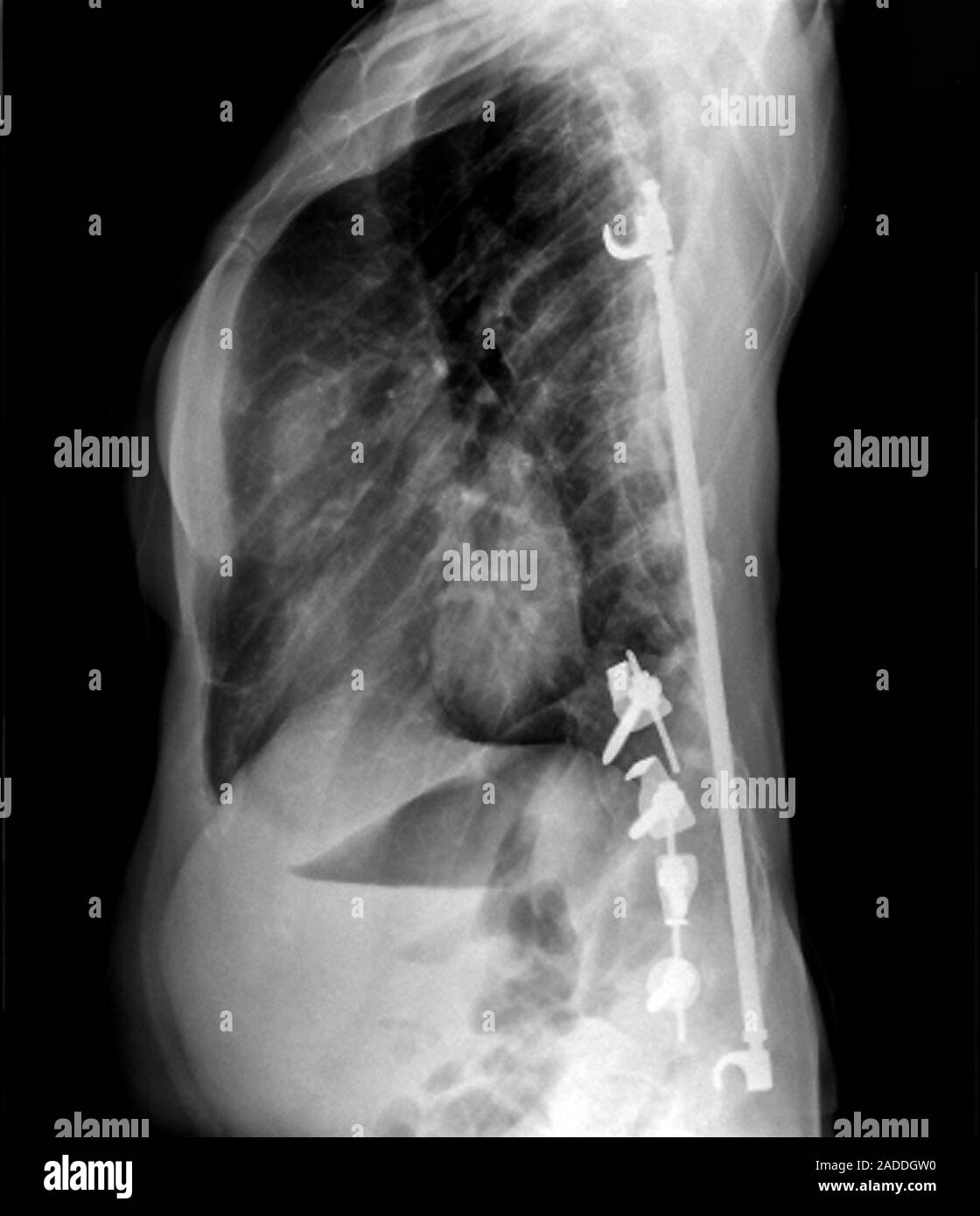 Harrington rod spinal implants in scoliosis. Lateral X-ray of the ...