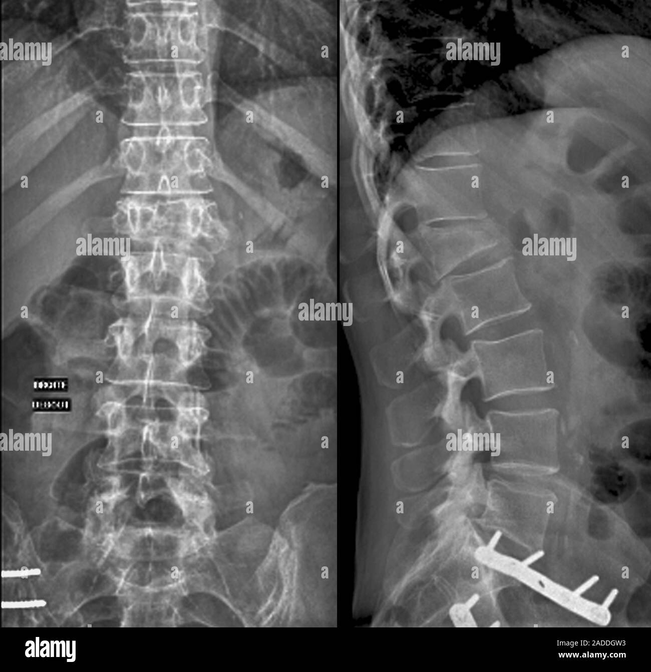 Compression fracture of a lumbar vertebra. Frontal (left) and lateral ...