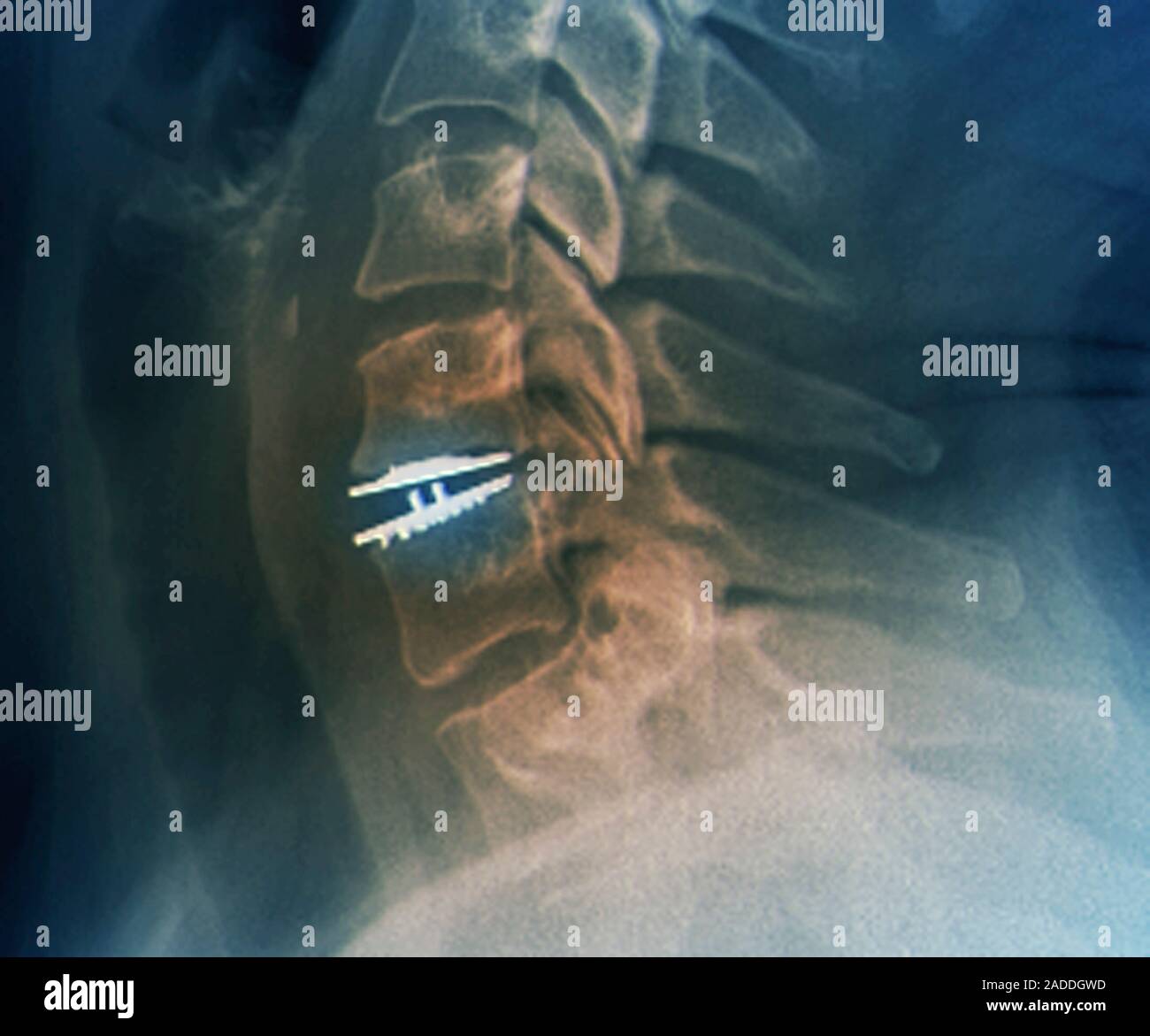Cervical intervertebral disc implant. Coloured lateral X-ray of the ...