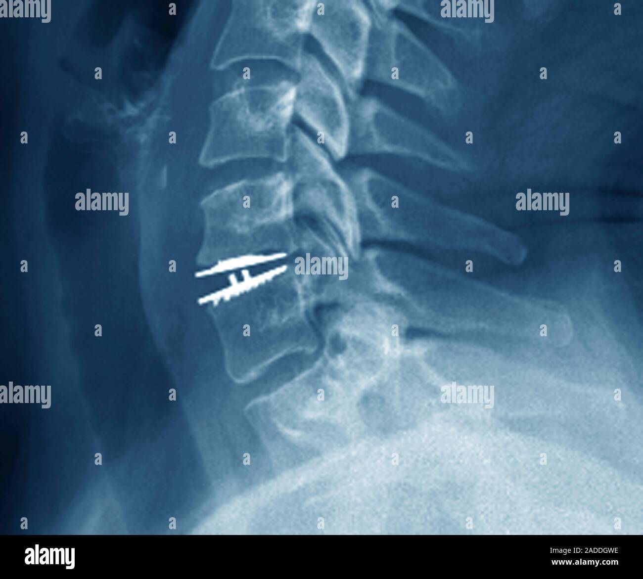 Cervical intervertebral disc implant. Lateral X-ray of the cervical ...