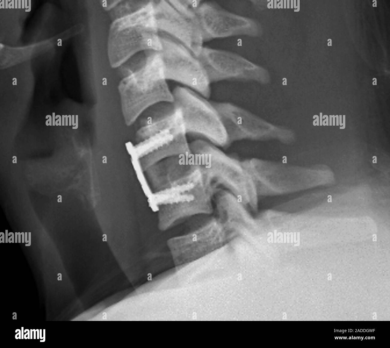 Cervical vertebral implant and repair. Lateral X-ray of the cervical ...