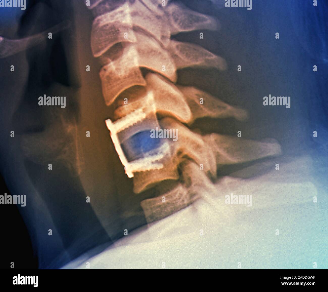 Cervical vertebral implant and repair. Coloured lateral X-ray of the ...