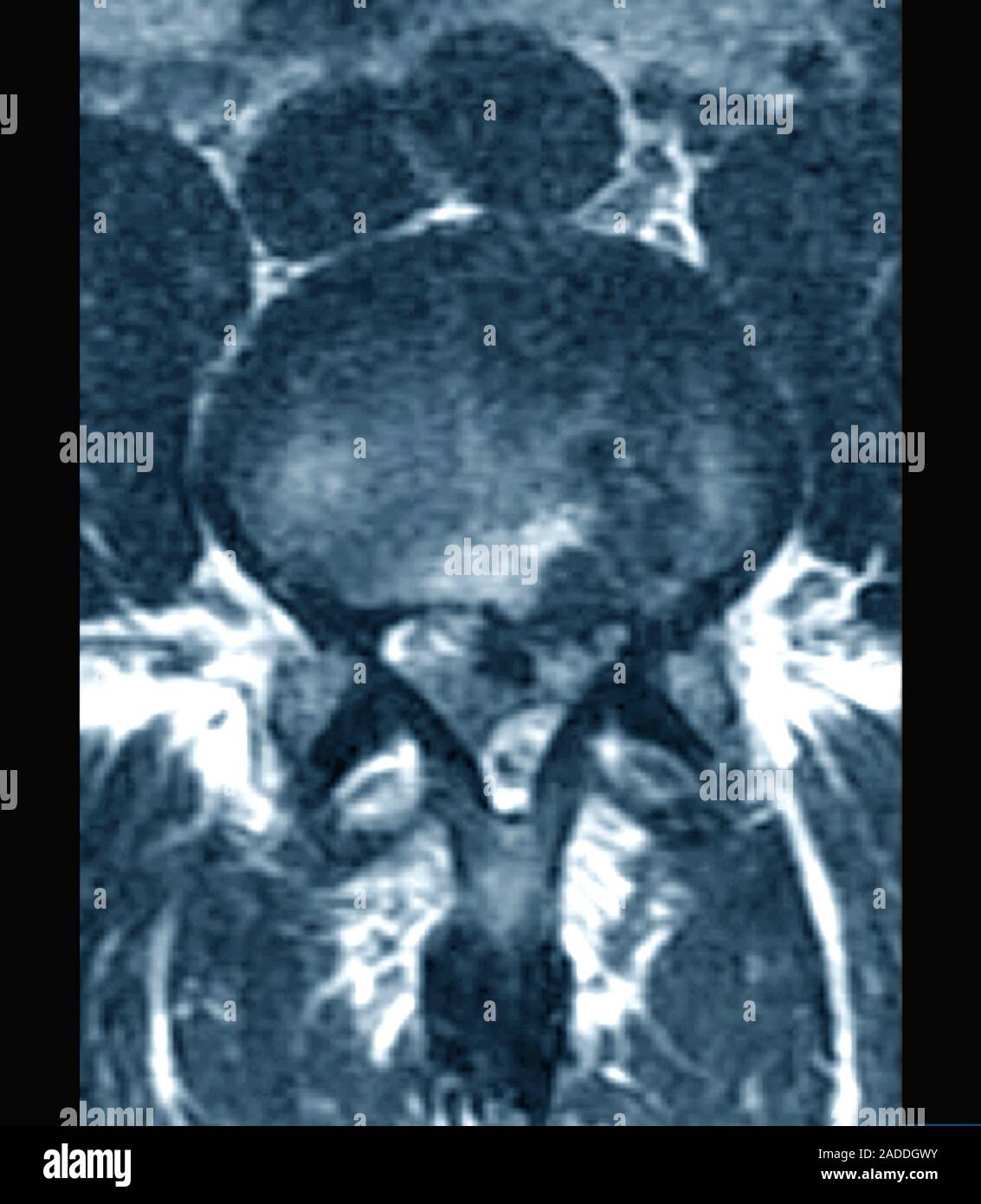 Slipped disc in the lumbar spine. Axial magnetic resonance imaging (MRI ...