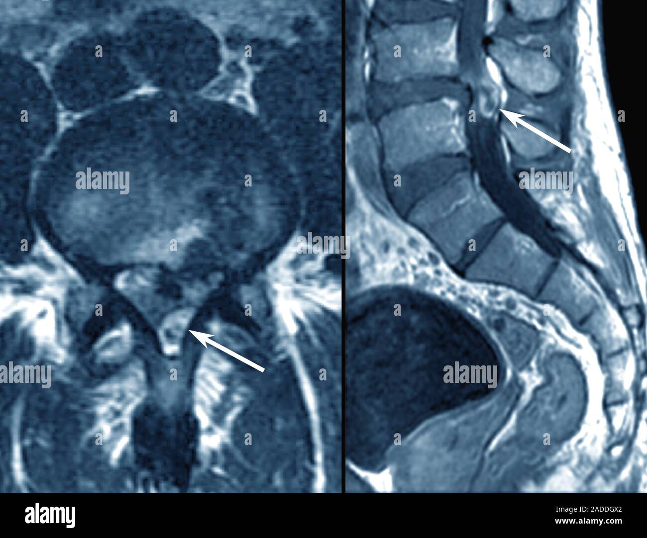 Slipped disc in the lumbar spine. Axial (left) and sagittal (right ...
