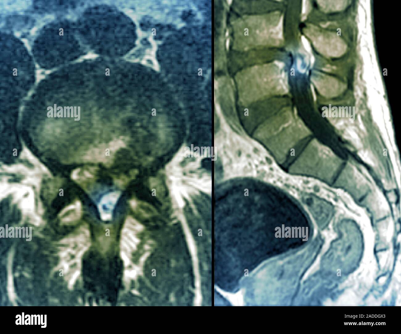 Slipped disc in the lumbar spine. Coloured axial (left) and sagittal ...