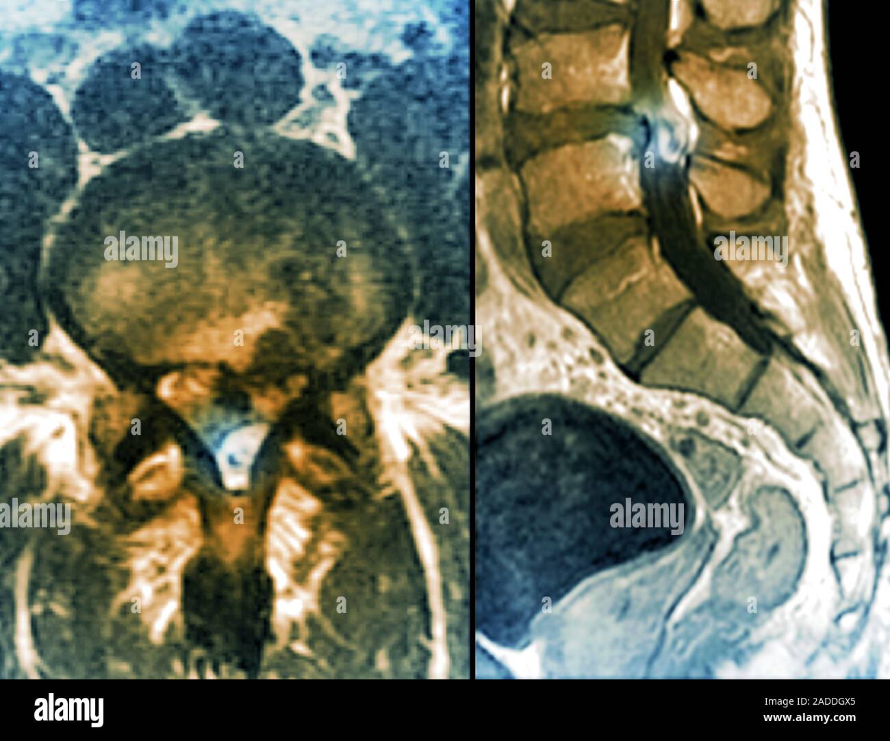 Slipped disc in the lumbar spine. Coloured axial (left) and sagittal ...