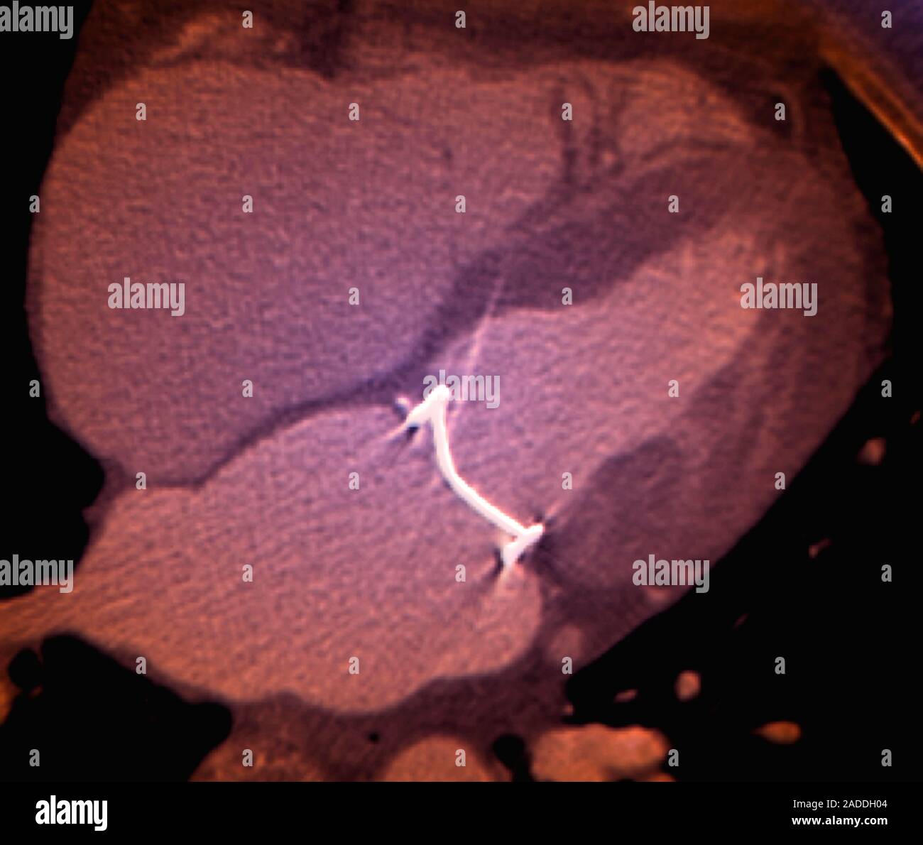 Mitral valve replacement. Coloured computed tomography (CT) scan ...