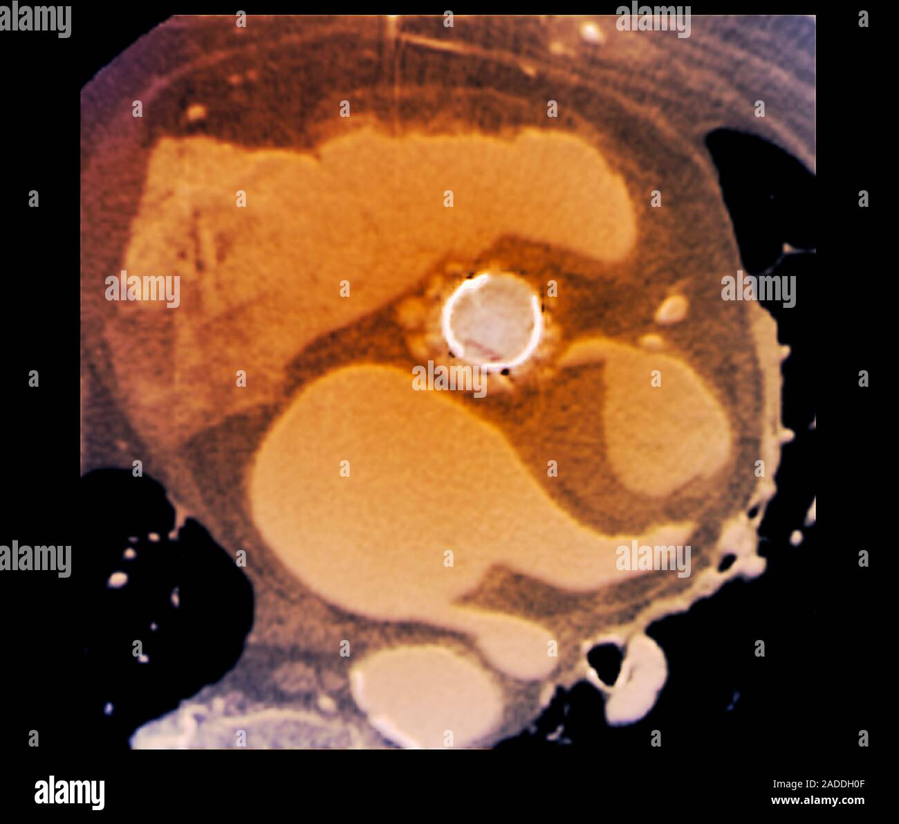 Aortic valve replacement. Coloured computed tomography (CT) scan ...