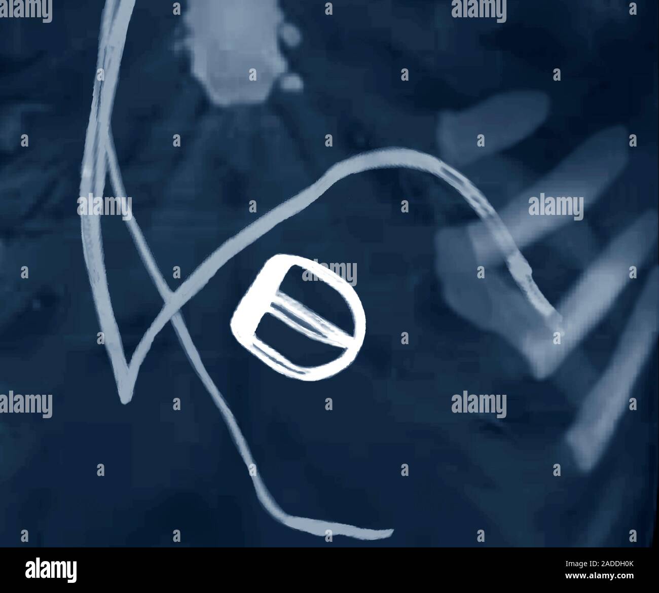Prosthetic aortic valve and pacemaker wires. Computed tomography (CT ...