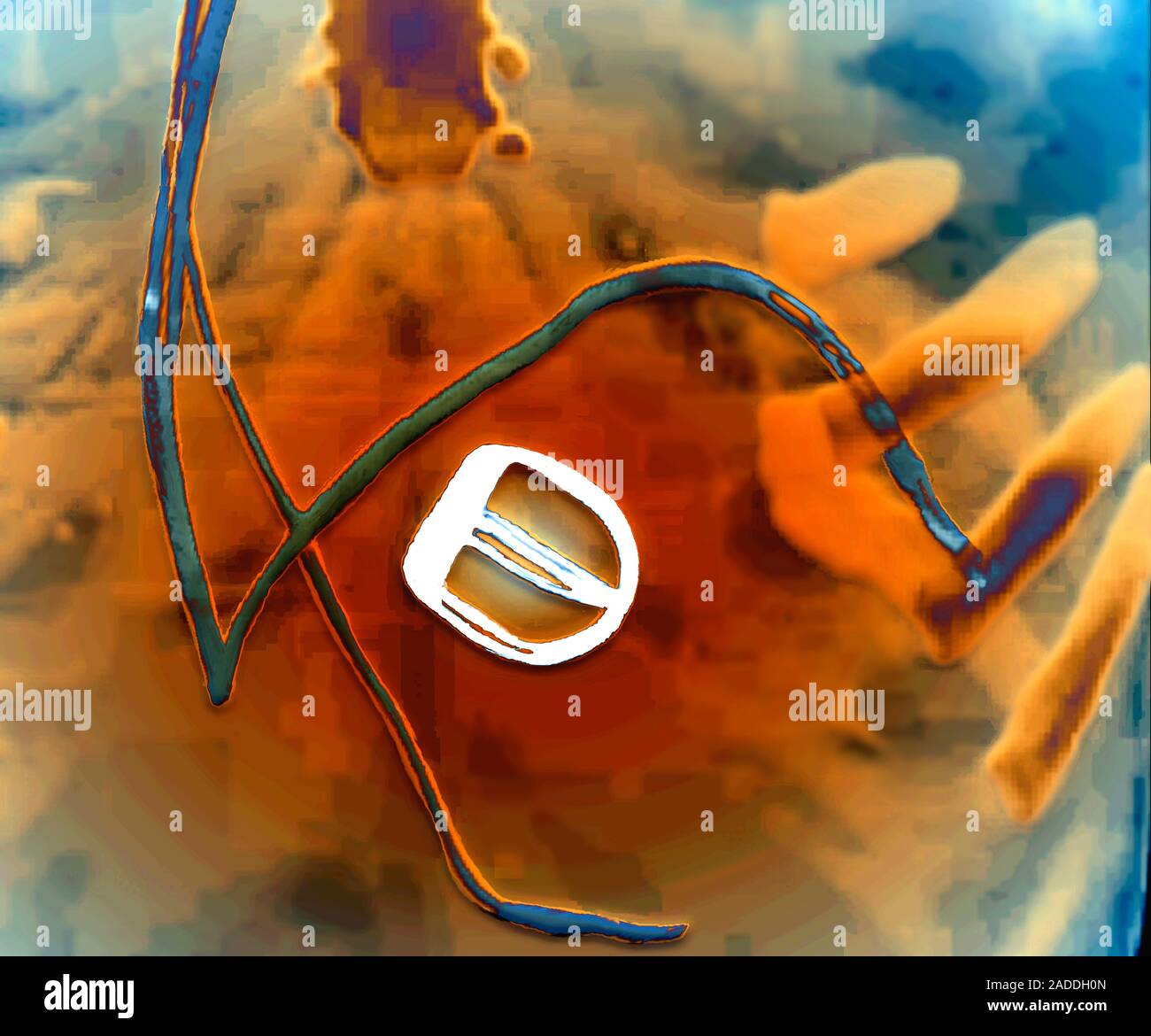 Prosthetic aortic valve and pacemaker wires. Coloured computed ...