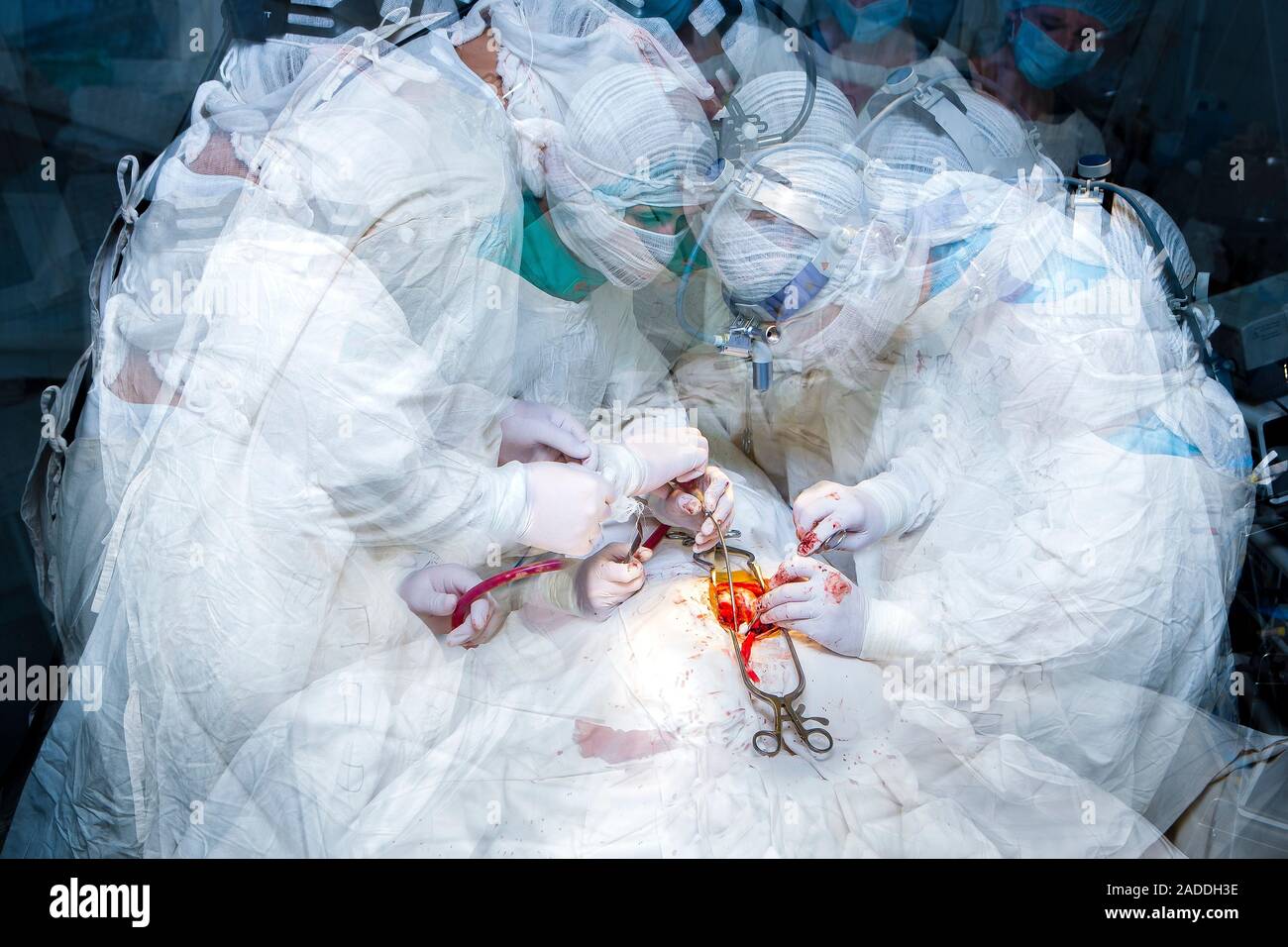 Spinal surgery, abstract image. Surgeons using head-mounted viewing ...