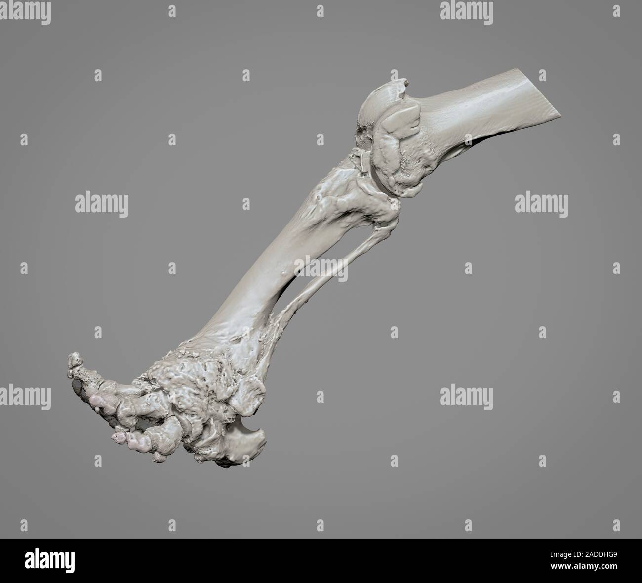 Arthritic elephant leg. Coloured 3D computed tomography (CT) scan of ...