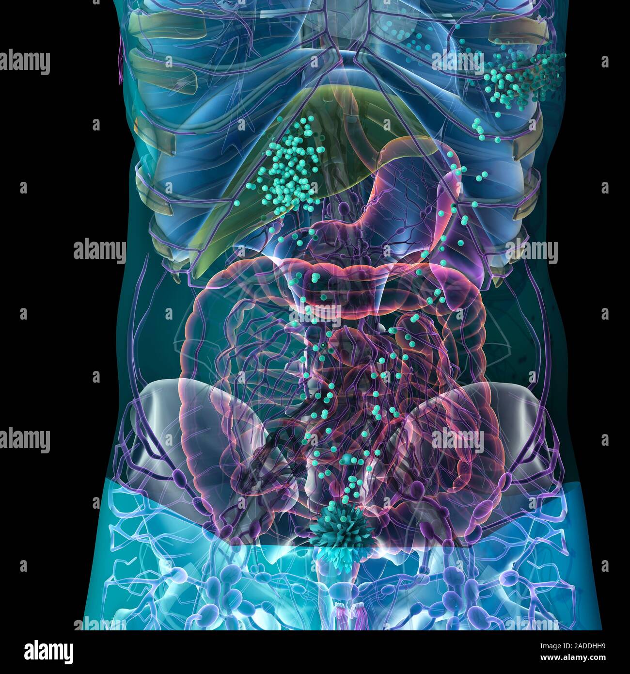 Cancer metastasis. Illustration of cancer cells (green) spreading ...