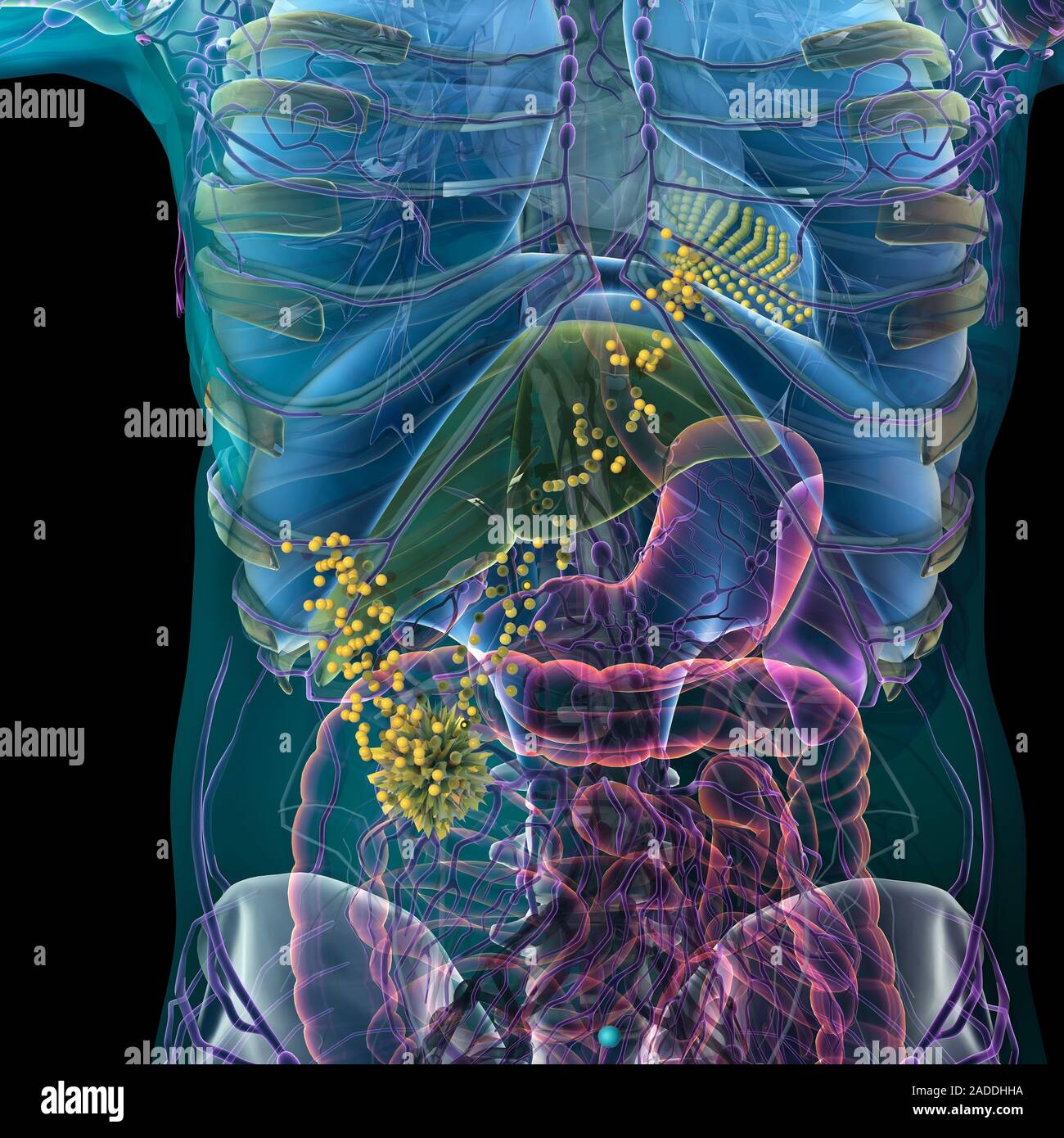 Cancer metastasis. Illustration of cancer cells (yellow) spreading ...