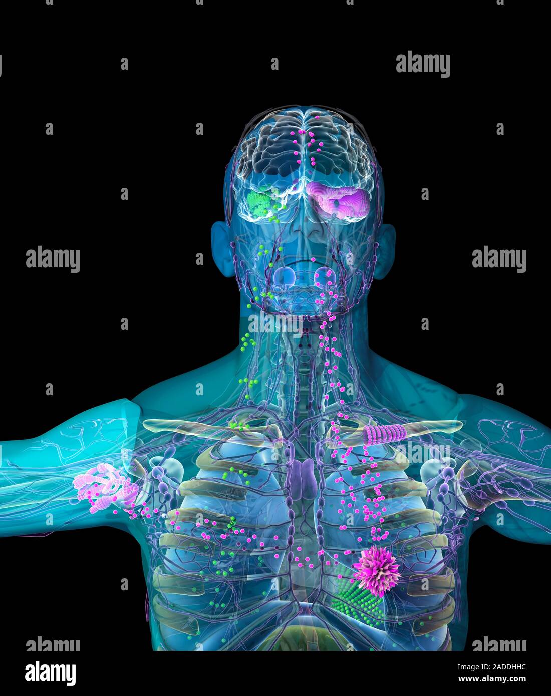 Cancer metastasis. Illustration of cancer cells (pink and green ...