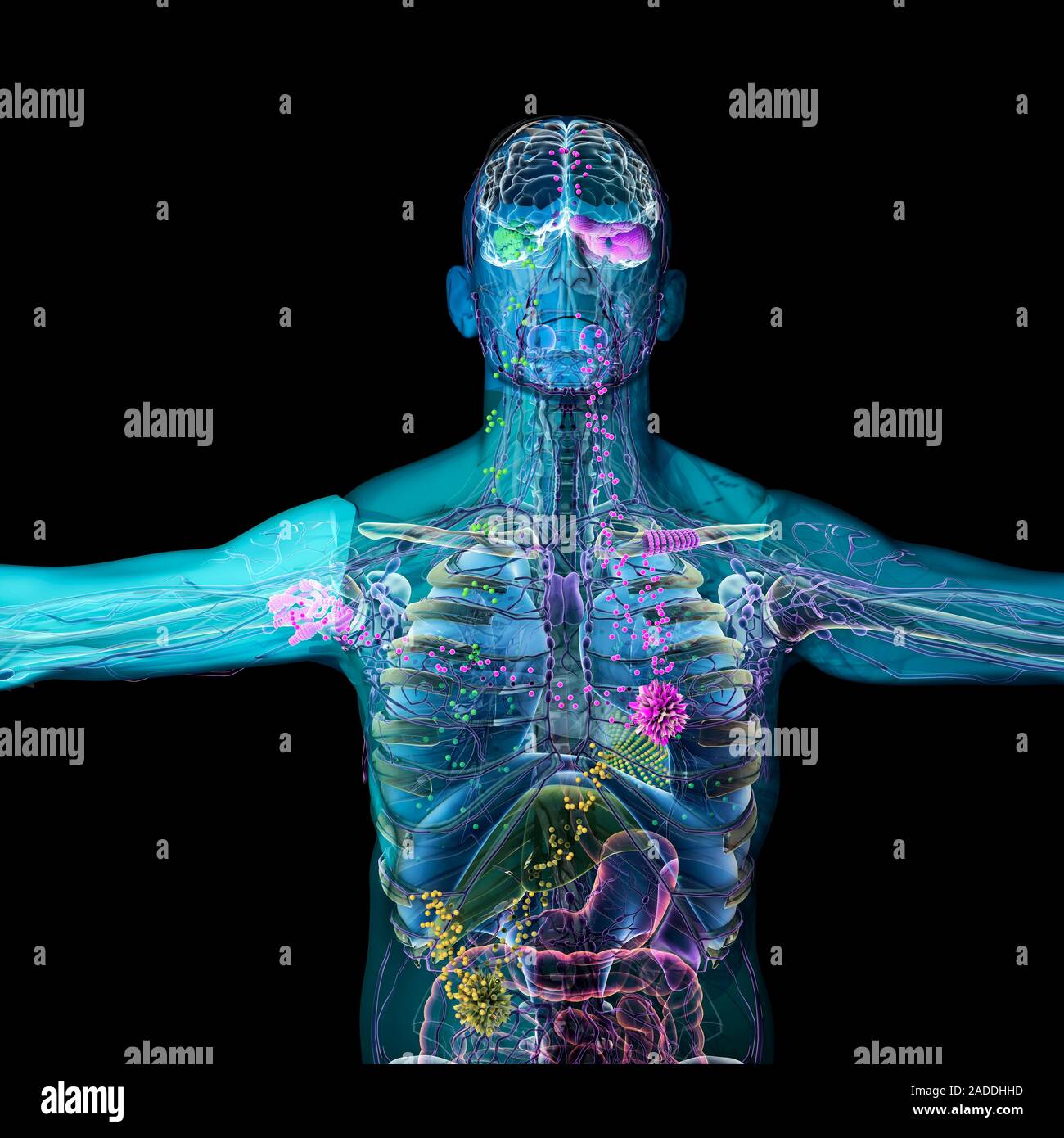 Cancer metastasis. Illustration of cancer cells (pink, green and yellow ...
