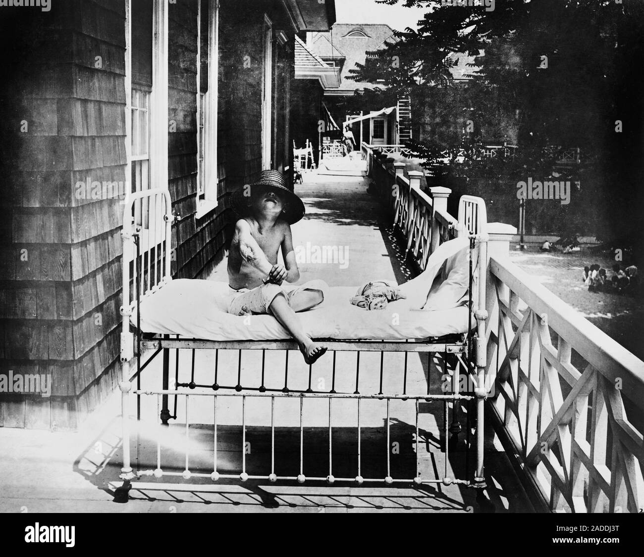 Child with tuberculosis. Tuberculosis (TB) is a bacterial infection ...