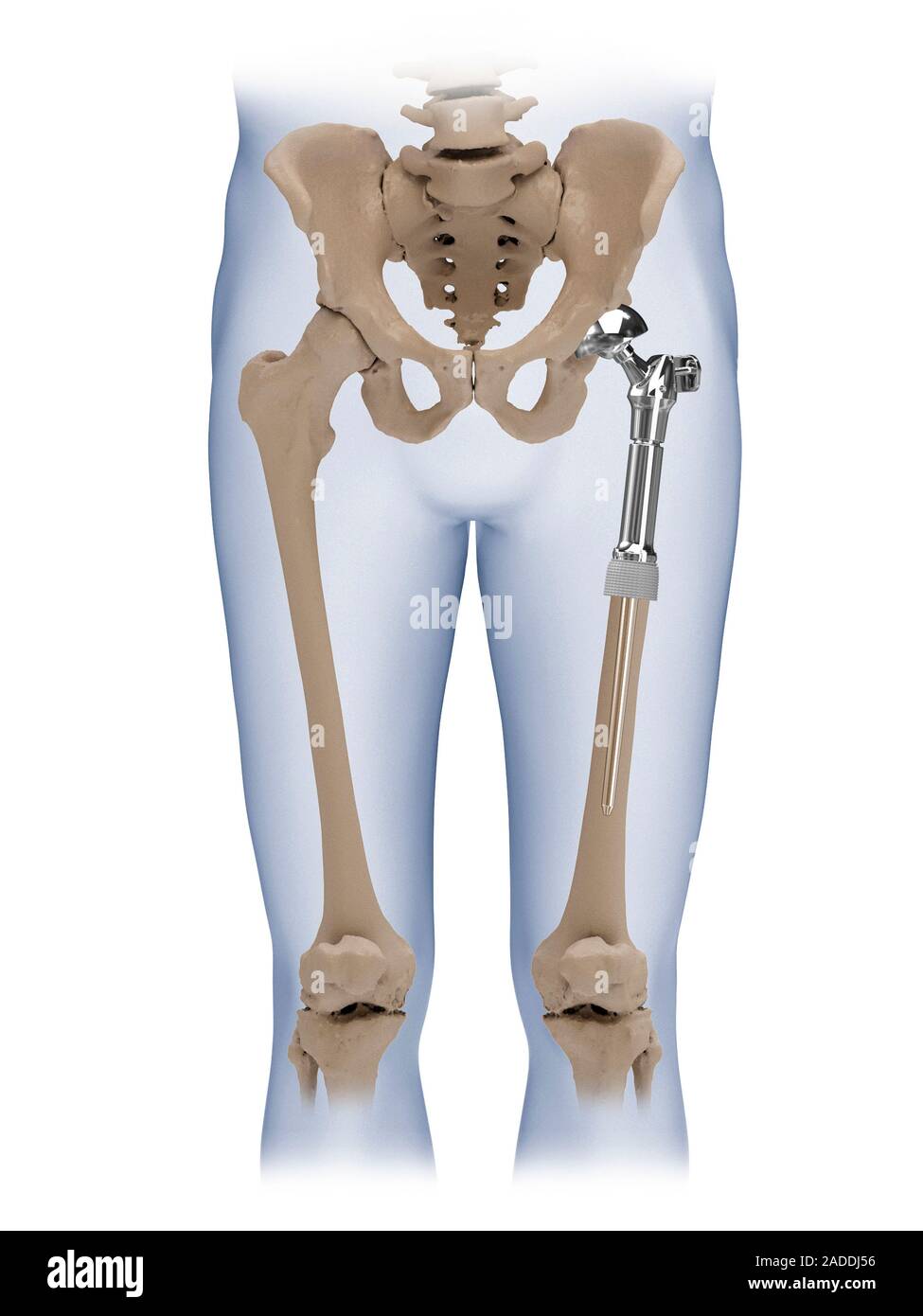 Proximal femoral replacement. Computer illustration showing the ...