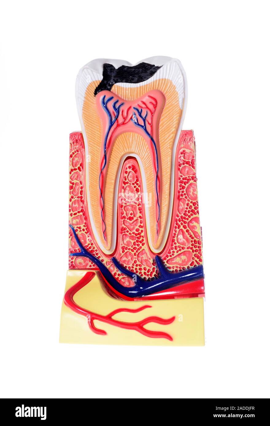 Tooth decay. Model of a section through a human tooth, showing tooth ...