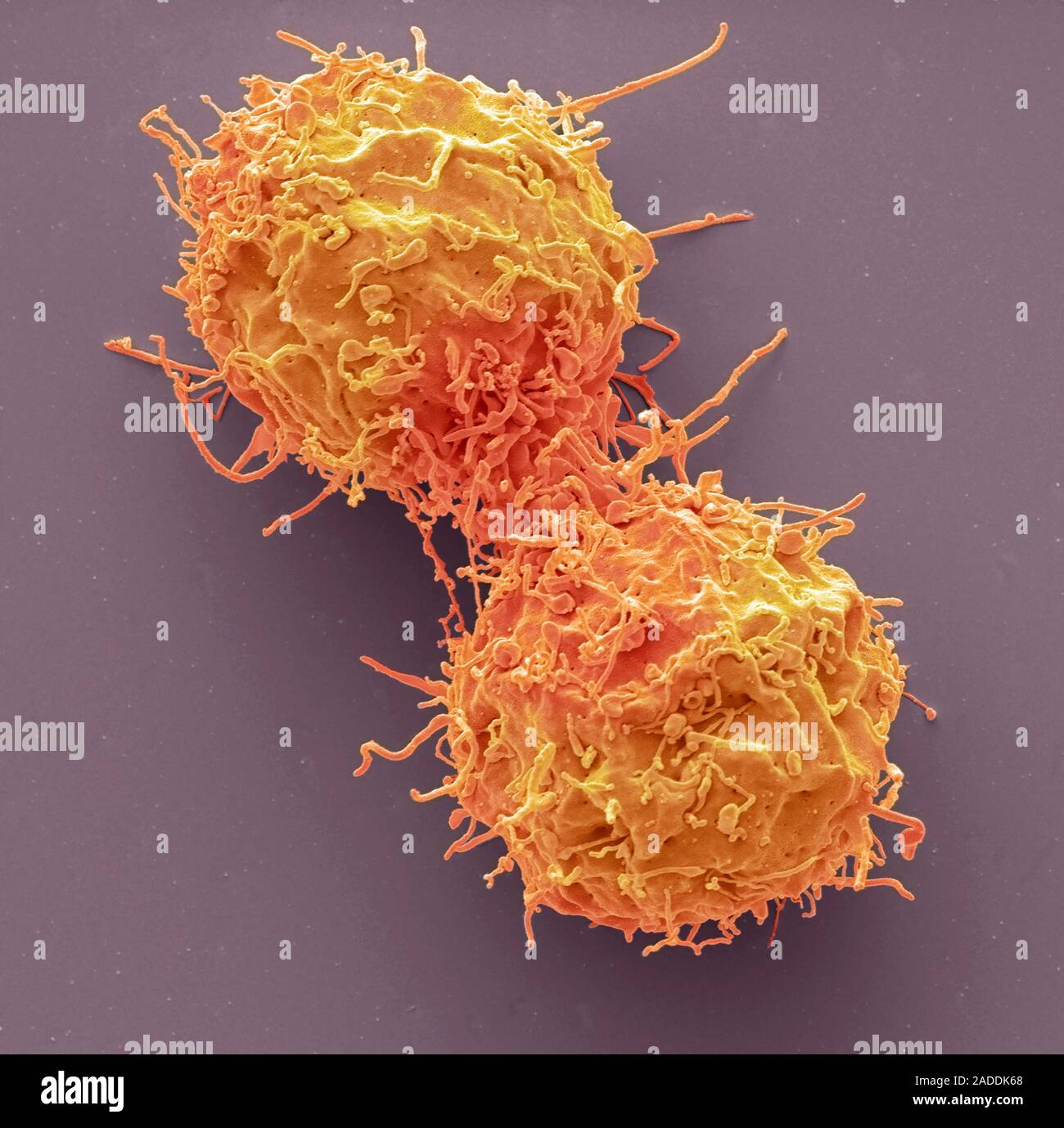 Dividing leukaemia cell. Coloured scanning electron micrograph (SEM) of ...