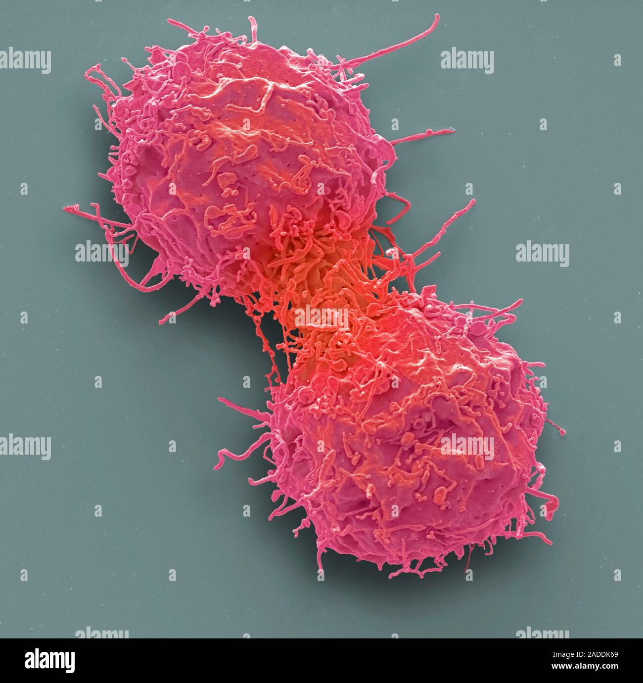 Dividing leukaemia cell. Coloured scanning electron micrograph (SEM) of ...