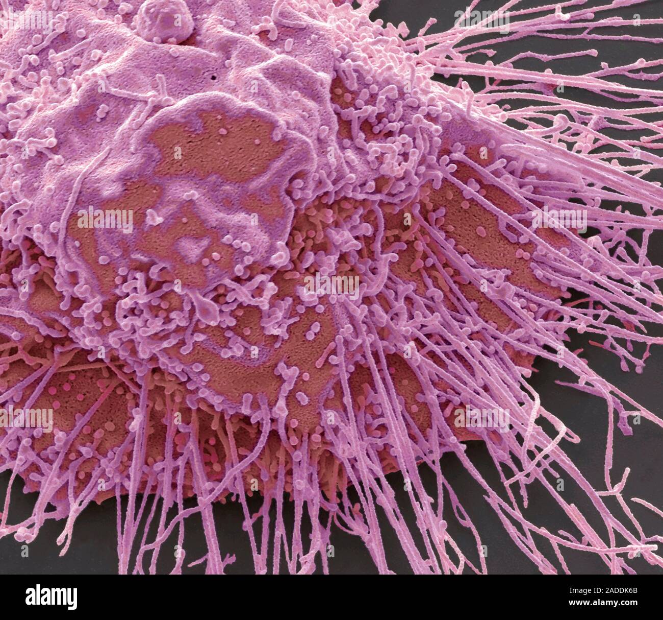 Liver cancer cell. Coloured scanning electron micrograph (SEM) of a ...