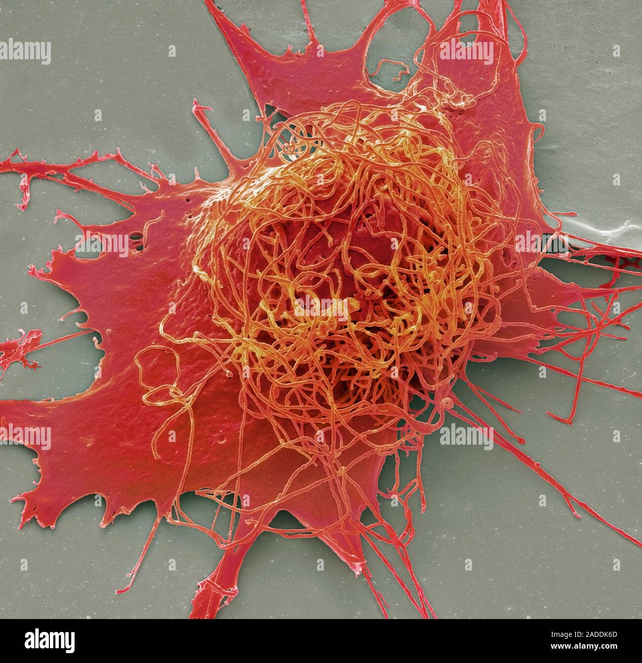 Liver cancer cell. Coloured scanning electron micrograph (SEM) of a ...