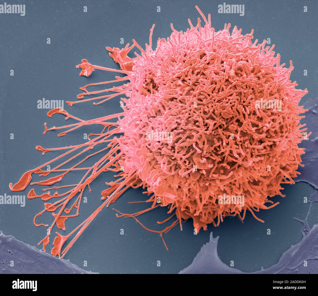 Liver cancer cell. Coloured scanning electron micrograph (SEM) of a ...