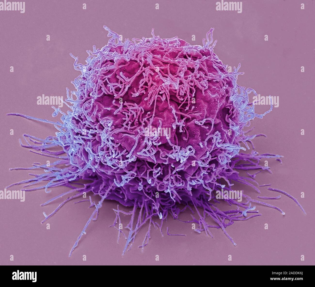 Leukaemia cell. Coloured scanning electron micrograph (SEM) of a ...