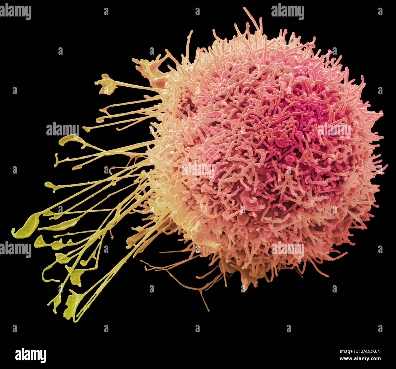 Liver cancer cell. Coloured scanning electron micrograph (SEM) of a ...