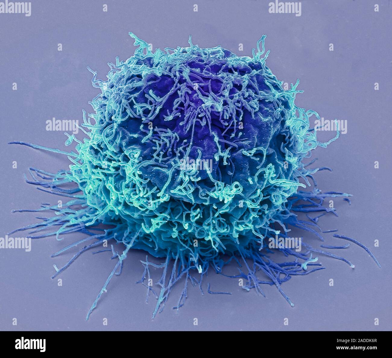 Leukaemia cell. Coloured scanning electron micrograph (SEM) of a ...
