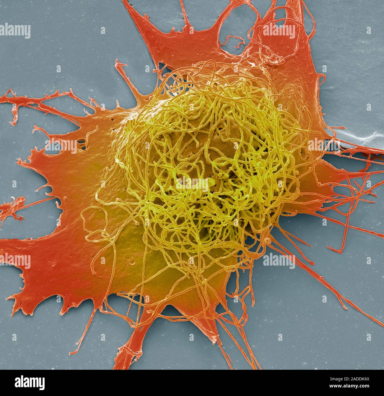 Liver cancer cell. Coloured scanning electron micrograph (SEM) of a ...