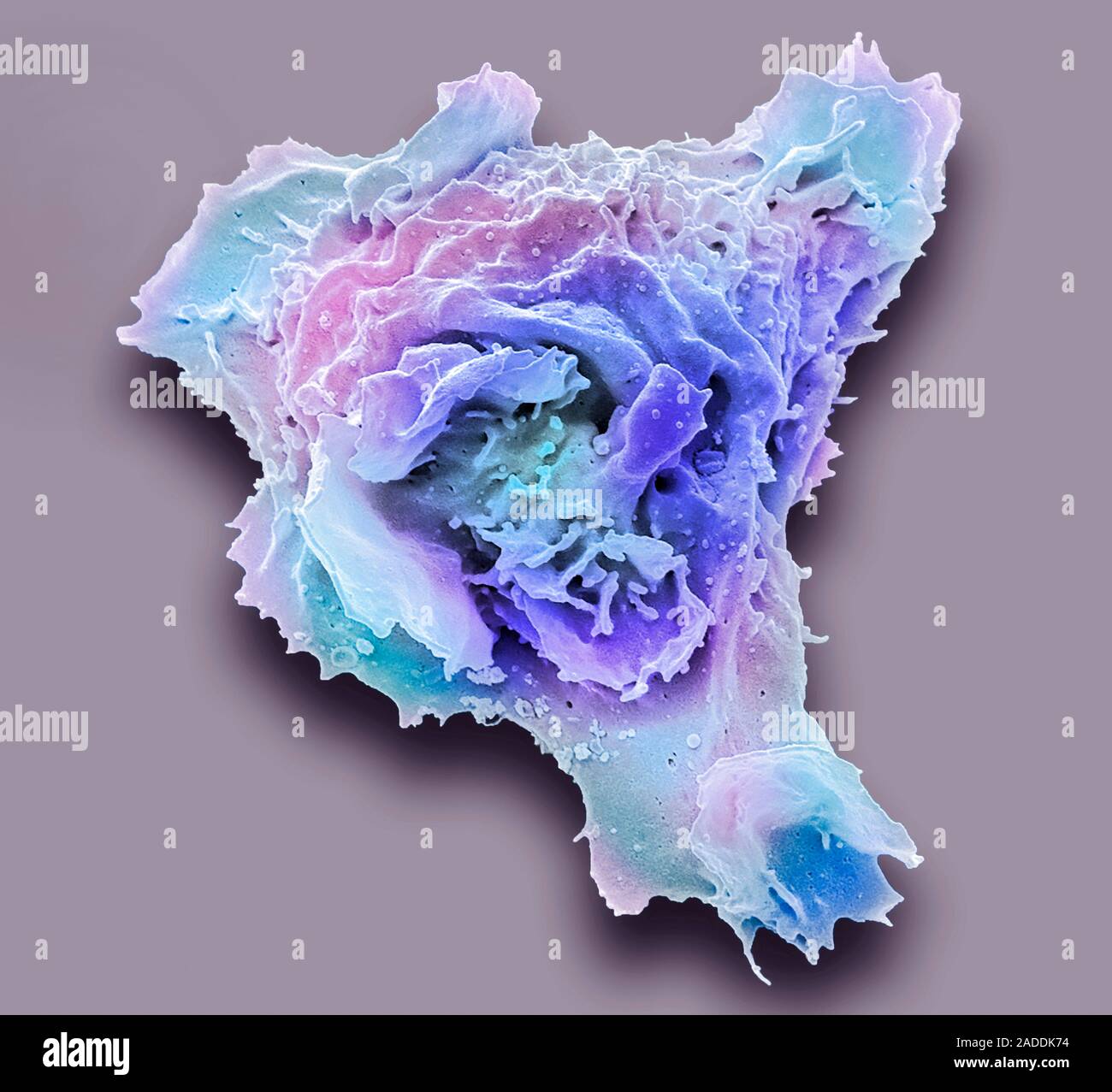 Leukaemia cell. Coloured scanning electron micrograph (SEM) of a ...