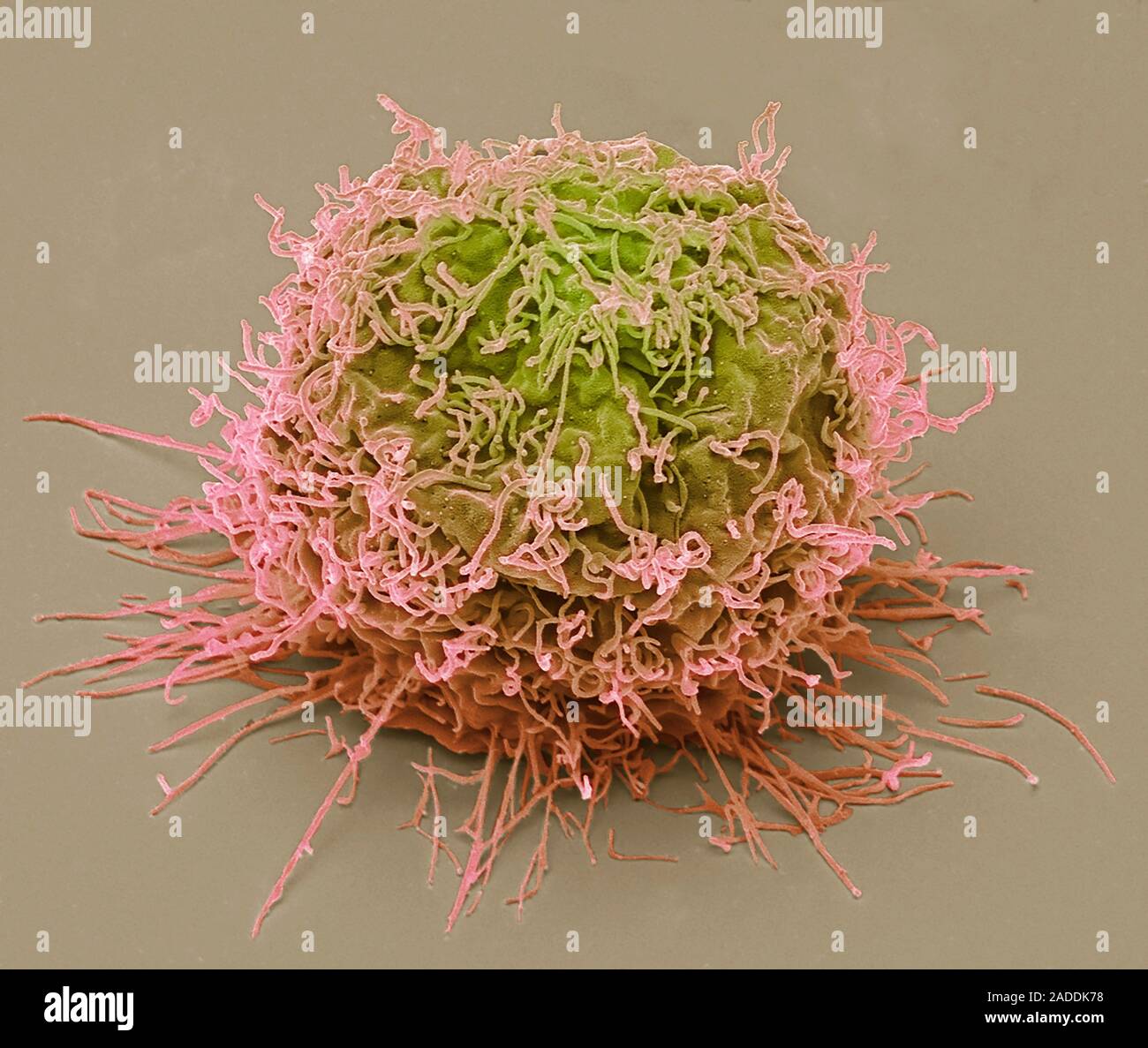 Leukaemia cell. Coloured scanning electron micrograph (SEM) of a ...