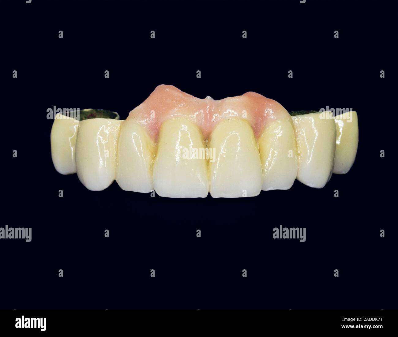 Ceramic dental bridge. Custom-made ceramic bridge with artificial gum ...