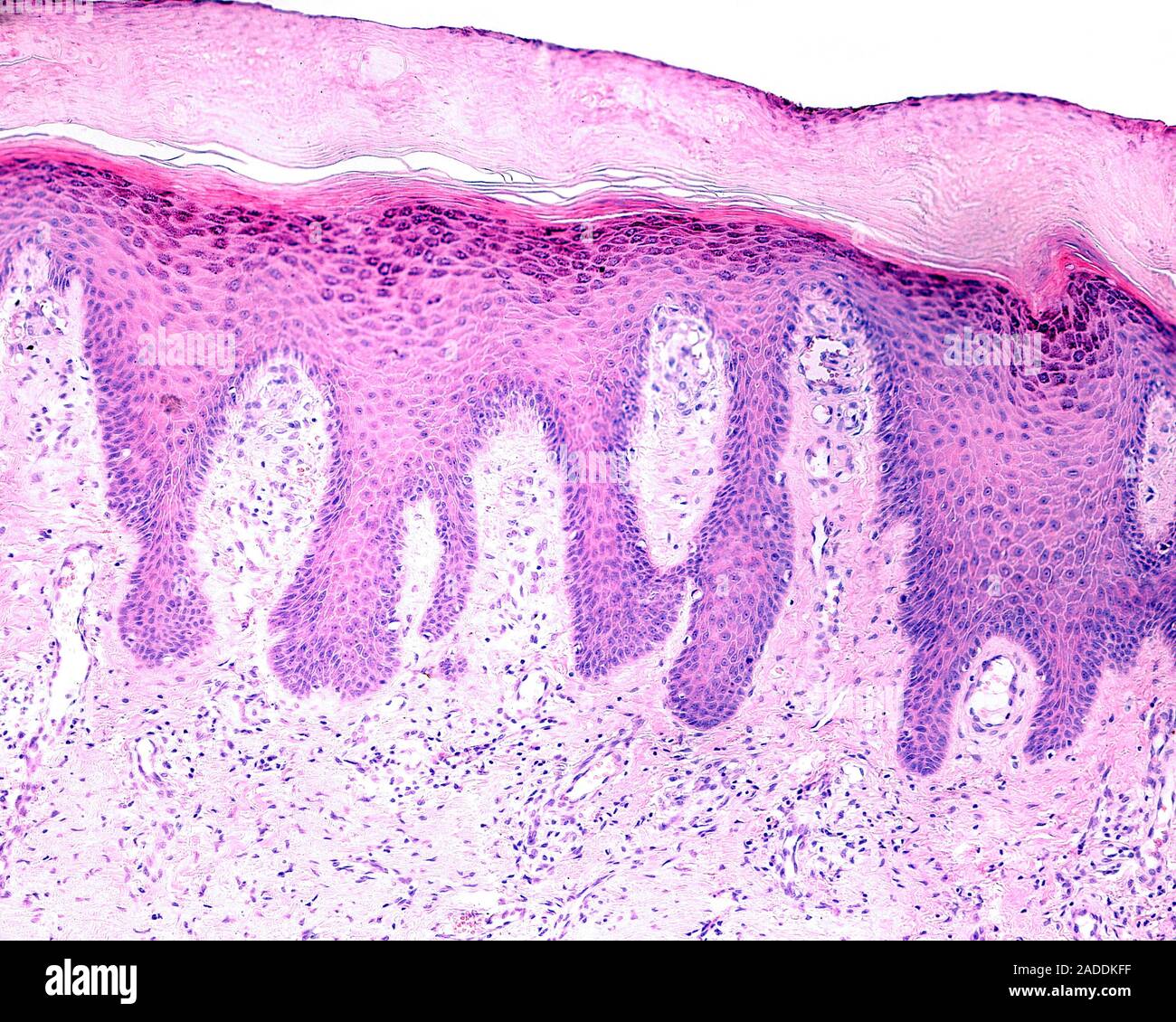 Light micrograph of a section through human skin with lichen planus. It ...