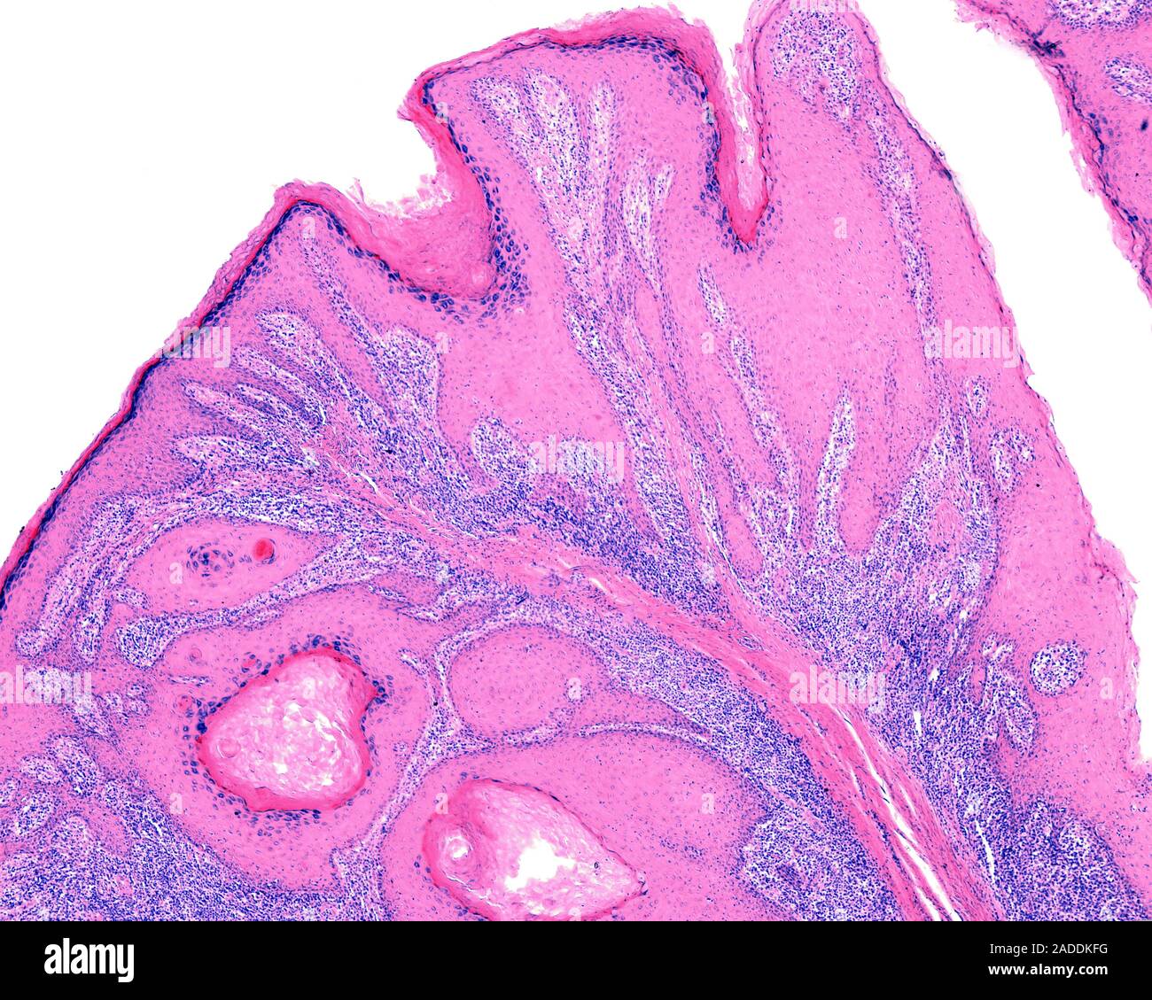 Light micrograph of a section through human skin showing a papilloma ...