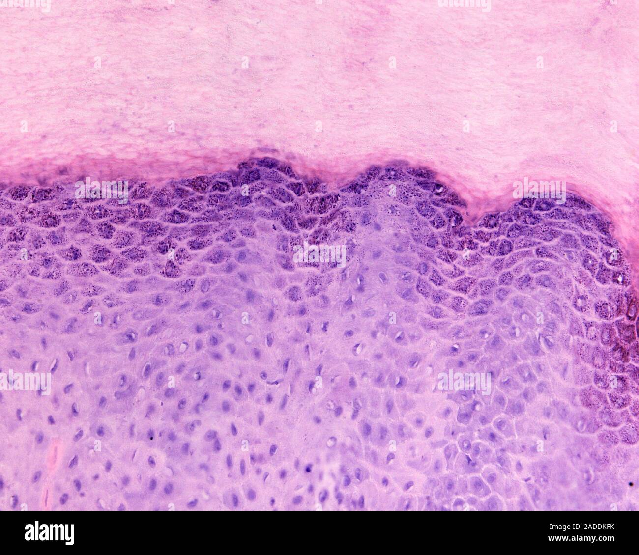 Light micrograph of a section through epidermis with a verruca, or ...