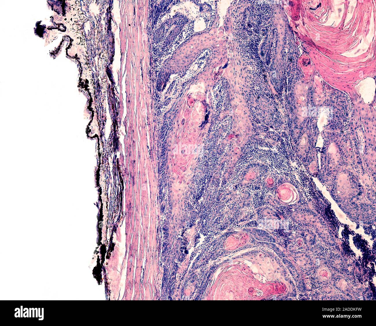 Squamous cell carcinoma of the surface of the eyeball, light micrograph ...