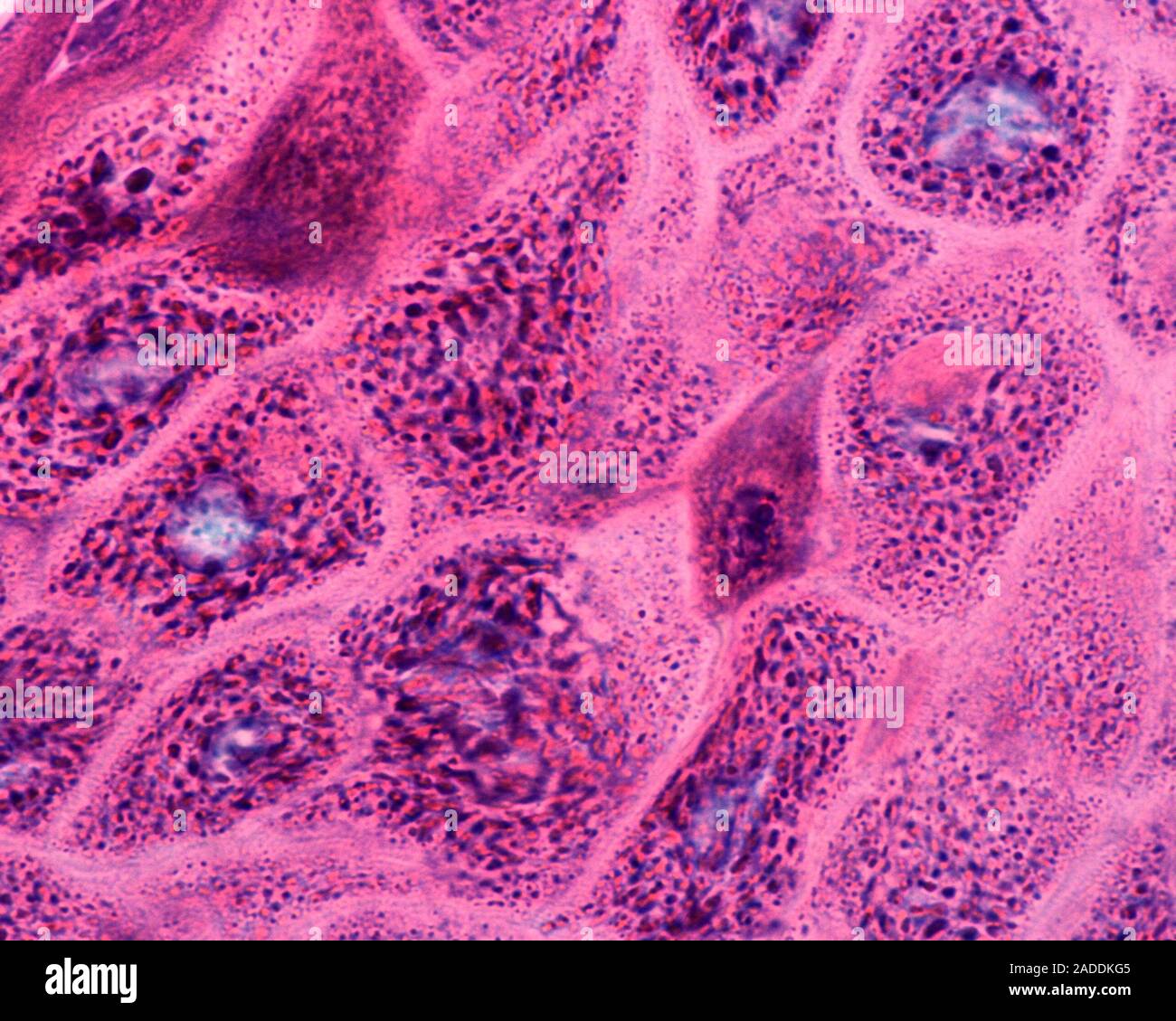 Light micrograph of a section through epithelium with hyperkeratosis ...