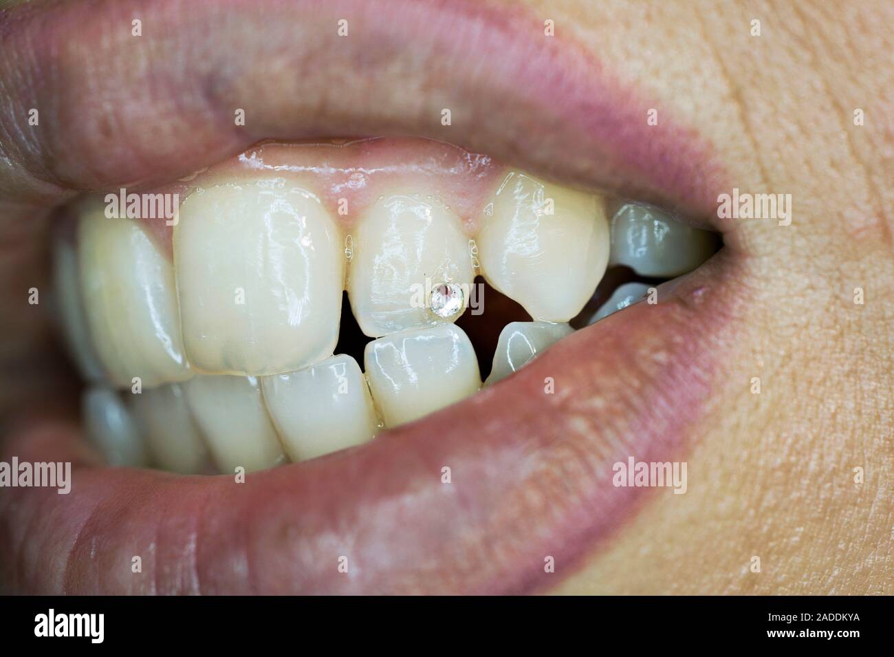 Diamond tooth gem glued to an upper incisor Stock Photo - Alamy