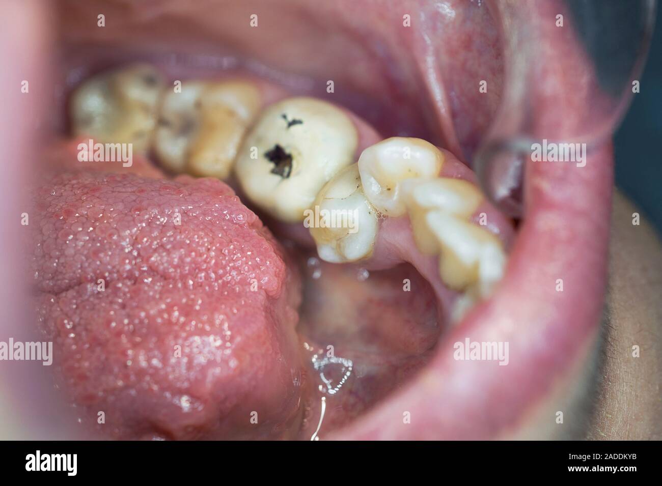 Lower teeth of a patient with an improper tooth eruption of the lower ...