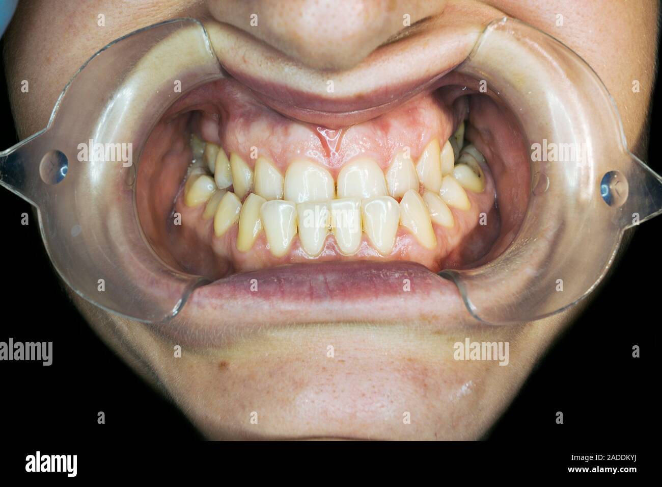 Close-up of the mouth of a patient with an underbite, showing the lower ...