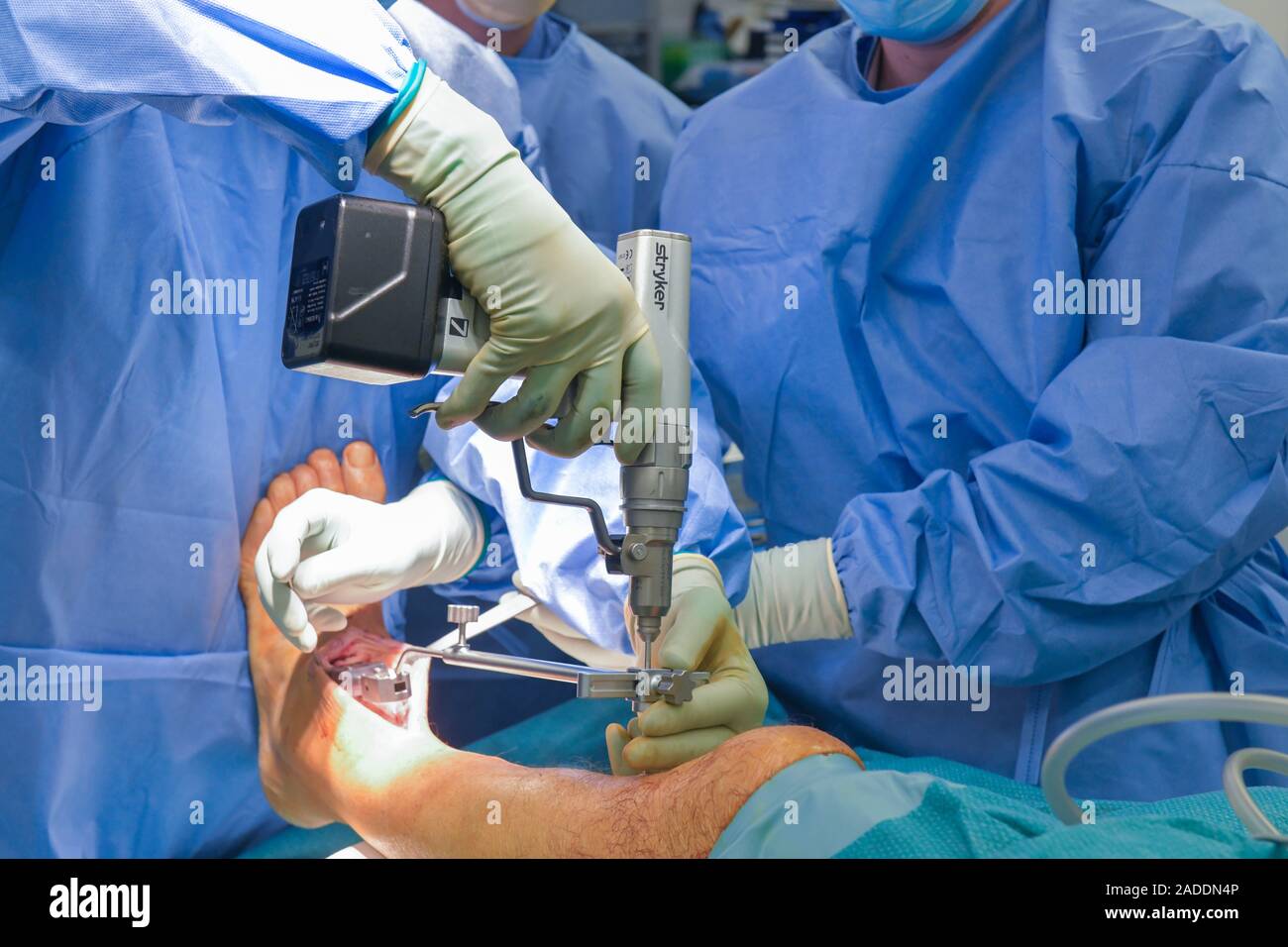 Total ankle replacement surgery. Close-up of surgeons carrying out a ...