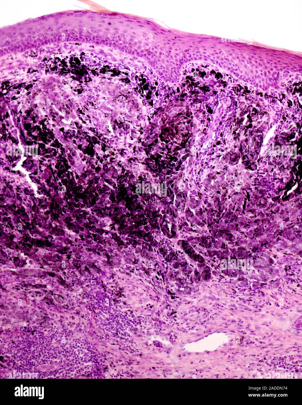 Heavily pigmented intradermal nevus, light micrograph. There are ...