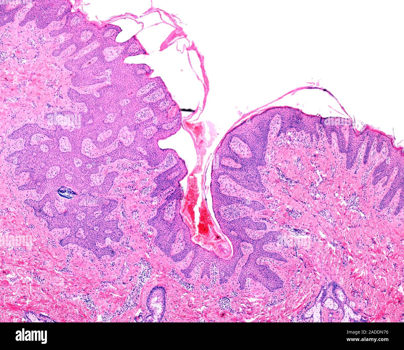 Papilloma, light micrograph. Papilloma of scalp where the border ...