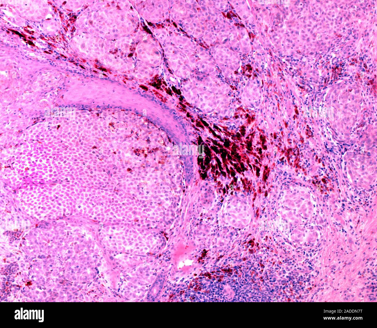 Nevoepithelioma, light micrograph. Group of atypical pigmented cells ...