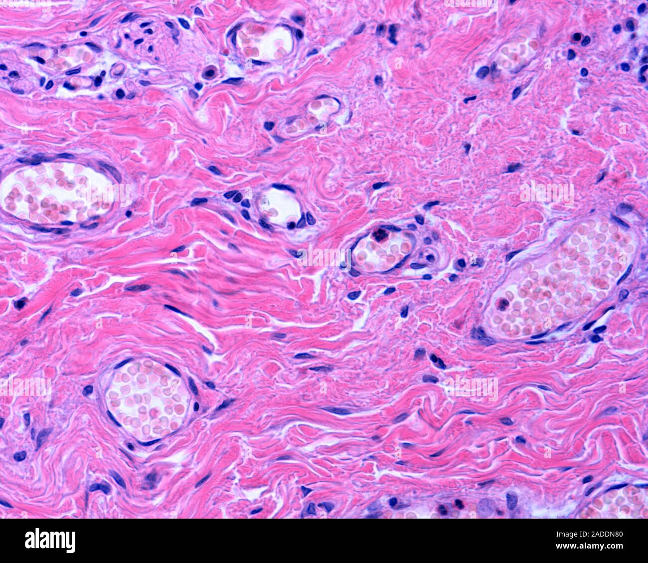 Dermis reticular of skin, light micrograph. The reticular dermis is a ...